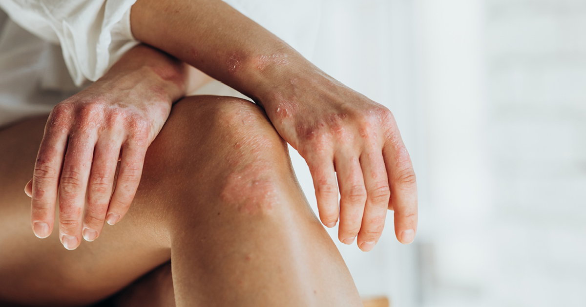 Psoriasis – Chronische inflammatoire huidaandoening